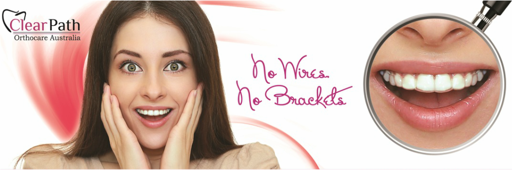 ClearPath Aligner | Invisible Braces - Normanhurst Dental